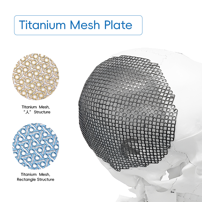 Titanium Mesh, "Λ" Structure for Craniofacial Reconstruction | CZMEDITECH